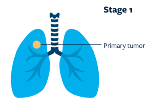 Lung Cancer Overview | Lung Cancer Research Foundation