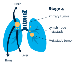 Lung Cancer Overview | Lung Cancer Research Foundation